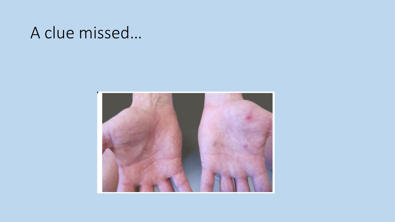 An otosyphilis case report presentation by Dr Aleksandra Sasha Jaksic